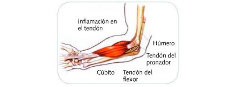 Epitrocleitis - Cirugía de Hombro en Guadalajara | Dr. Esteban Castro ...