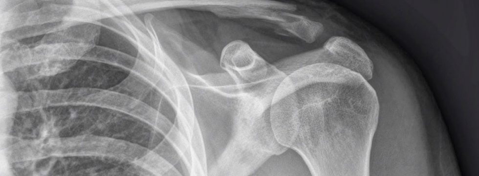 ¿Qué Tipo de Hueso es el Hombro? - Cirugía de Hombro en Guadalajara ...